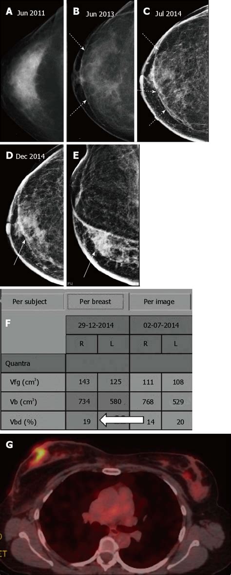 Figure From Imaging Of The Treated Breast Post Breast Conservation Surgery Oncoplasty