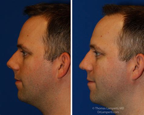 Turned Up Nose The Nose Tip Might Seem Unnaturally Upturned In 1 Week