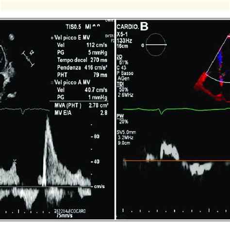 Transthoracic Echocardiography Evaluating Diastolic Function A Download Scientific Diagram