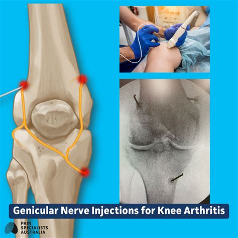 How Long Does Genicular Nerve Block Last Pain Specialists Australia