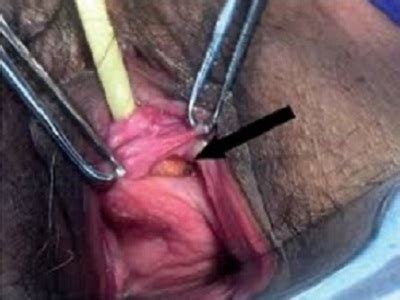 Partial Sling Removal Surgery Miklos Moore Urogynecology