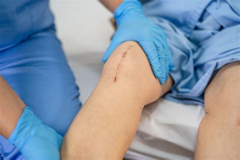 Partial Knee Replacement Scar