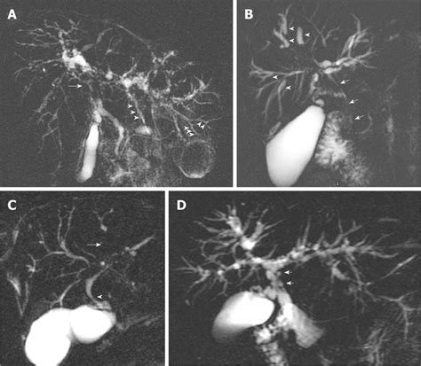 Magnetic Resonance Cholangiopancreatography Annotating Typical Features Download Scientific