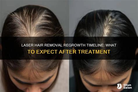 Laser Hair Removal Regrowth Timeline What To Expect After Treatment