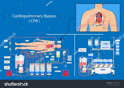 Cardiopulmonary Bypass Heart Lung Machine Coronary เวกเตอร์สต็อก ปลอด