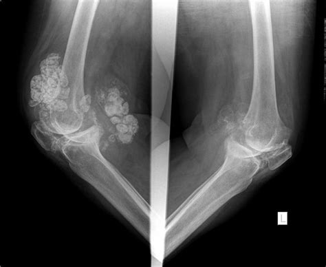 Viewing Playlist Aa Junepin Elbow Xray Knee X Ray