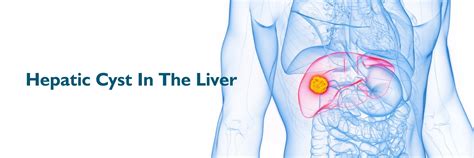 Hepatic Cyst Giant Hepatic Cyst Determining Secondary Budd Chiari