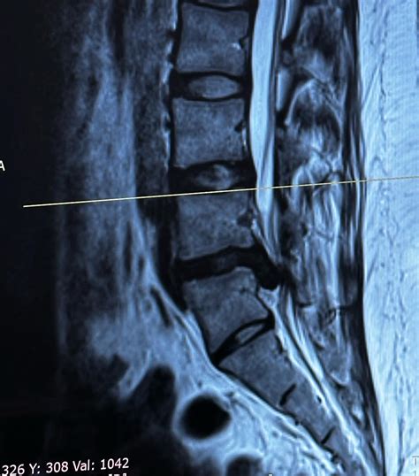 Injection Incoming Rsciatica