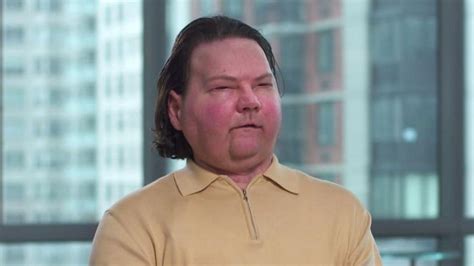Man Undergoes 1st Successful Face Double Hand Transplant From Same