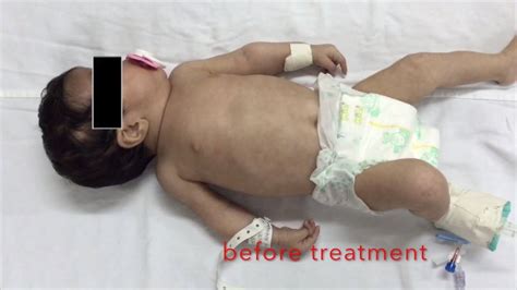 Recovery Of Pseudoparalysis Of Parrot In An Infant With Congen In This Rediscovering The