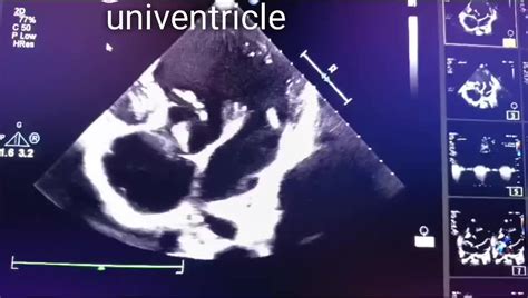 Selvakani Ramakrishnan On Linkedin Single Ventricle 25 M S P Glenn Shunt Procedure Guess If