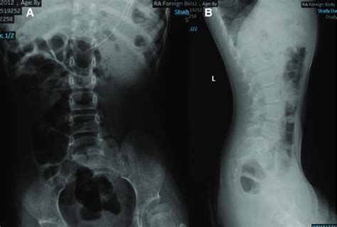 Metal Strip Had Advanced To The Distal Duodenum Duodenojejunal Flexure Download Scientific