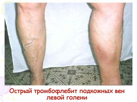 Тромбофлебит поверхностных вен нижних конечностей презентация онлайн