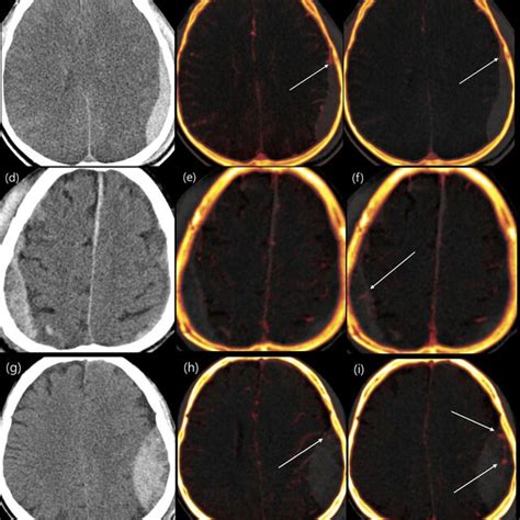 Classification Of Contrast Leakage Patterns Dual Energy Ct Images