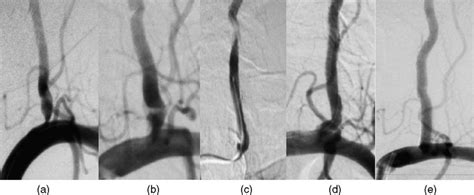 A Stenosis Of The Left VA Origin B Dissection Both In The Distal V Download Scientific