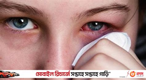 চোখ ওঠা সমস্যায় যা করবেন