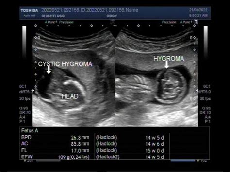 Cystic Hygroma Ultrasound