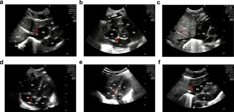 Examples Of Different Uvc Tip Ultrasound Views A Subcostal Sagittal