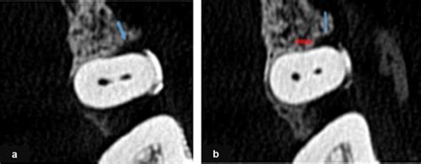 Cbct Axial Cuts Showing Combined Angular Bone Defect Mesial To Upper Download Scientific