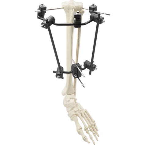 China Φ Series External Fixation Fixator Proximal tibia semicircular frame factory and