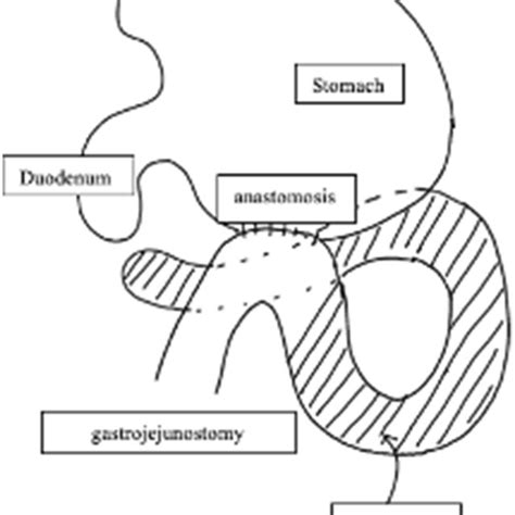 Blind Loop Secondary To Duodenojejunostomy Download Scientific Diagram