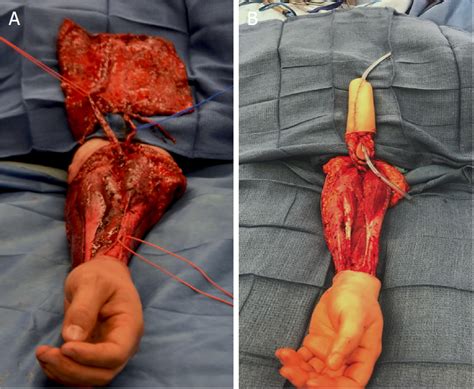 Phalloplasty Before And After