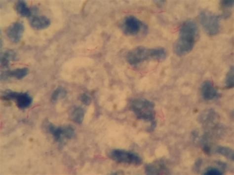 Tuberculosis Bme 1 Object Detection Dataset By Tuberculosisdetectionaiaryo1