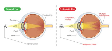 Refractive Laser Surgery Ishaq Eye Hospital
