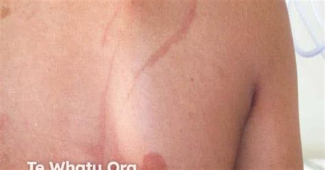 Phytophotodermatitis Image