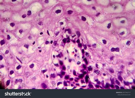 Cancer Cervix Light Micrograph Cervical Biopsy Stock Photo Shutterstock