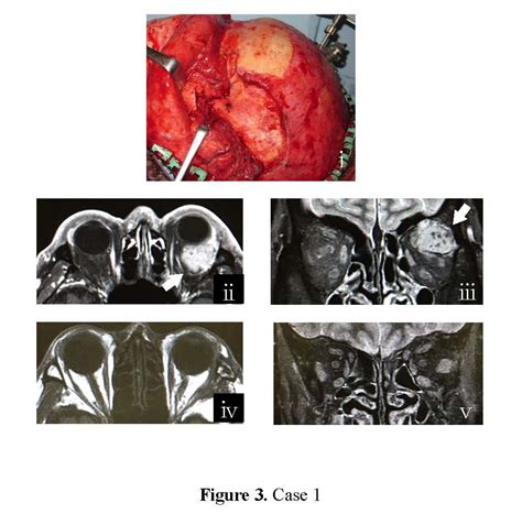 Location Based Surgical Approaches For Orbital Tumor Resection