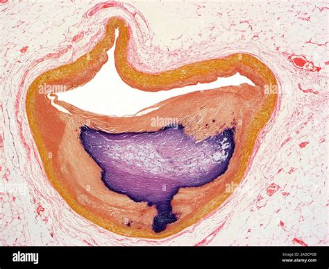 Atherosclerosis Light Micrograph Lm Of A Section Through An Artery Showing An Atheroma Fatty