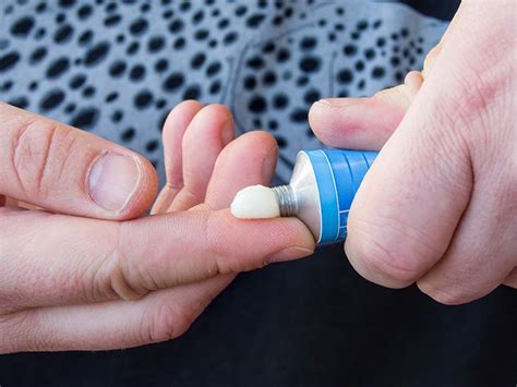 Fluocinonide Uses Side Effects And More