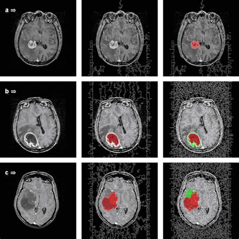 Segmentation Of Tumors In Magnetic Resonance Brain Images Using An Interactive Multiscale