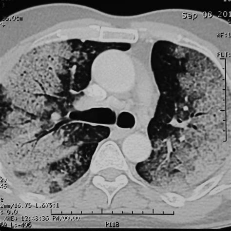 CECT Thorax Showing Bilateral Upper Lobe Centrilobular Nodules With Download Scientific