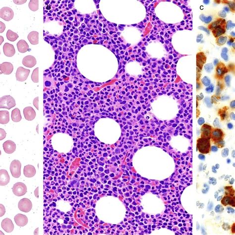 Morphologic Features Of Mdsmpn With Sf3b1 Mutation And Thrombocytosis Download Scientific