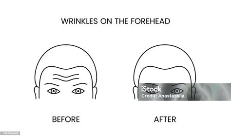 이마의 주름 시술 전과 벡터에 치료 라인 아이콘을 적용한 후의 레이저 미용 매끄럽고 깨끗한 피부와 주름을 가진 남자의 그림