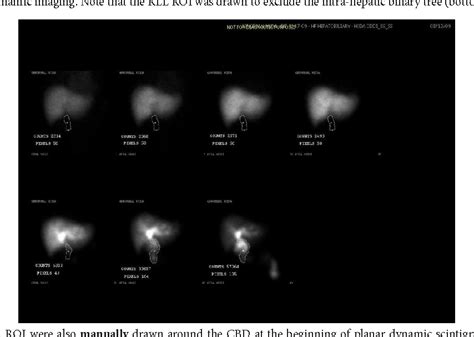 Figure 2 From A New Approach To Identify Sphincter Of Oddi Dysfunction Semantic Scholar