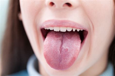 Oral Manifestations Of A Gluten Disorder Mouth Sores Tongue Spots