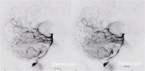Posterior Cerebral Artery