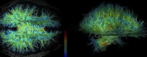 Diffusion Tensor Imaging Dti Cutting Edge Brain Imaging
