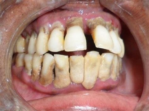 And 2 Clinical Difference Between Supra Gingival Calculus And