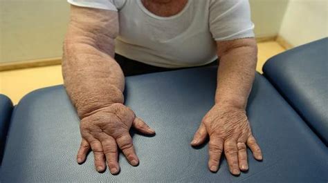 Differences Between Lipedema And Lymphedema