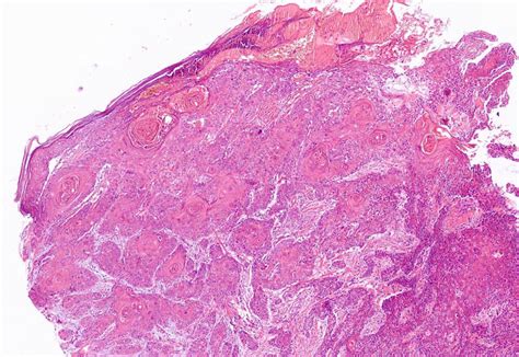 Scalp Lesion Well‐differentiated Squamous Cell Carcinoma Download Scientific Diagram
