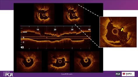 Cracking The Calcium Code Novelty And Utility Of Hertz Contact Intravascular Lithotripsy