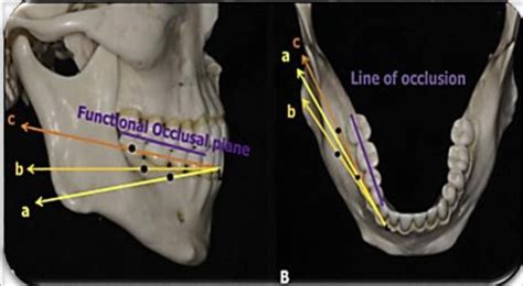 Comparison Of The Force Vector In Each Device A Lateral View B