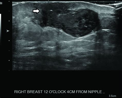 Epidermoid Cyst In Male Patient Mimicking A Suspicious Breast Mass And