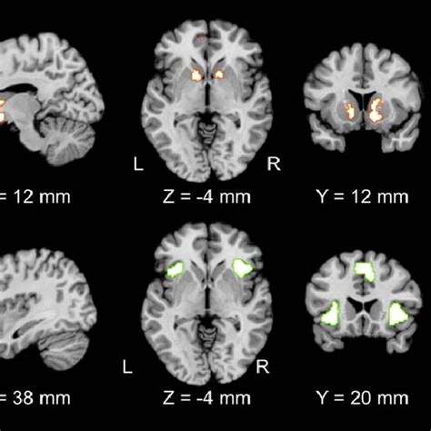 Pdf Social Comparison In The Brain A Coordinate Based Meta Analysis
