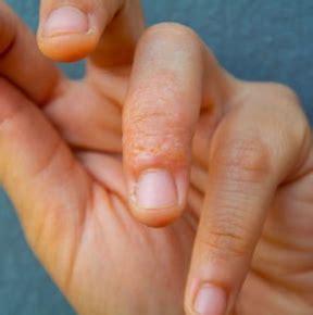 Dyshidrotic Eczema Symptoms Pictures Causes Treatment