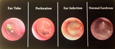 Np Ear Guidelines Review Flashcards Quizlet